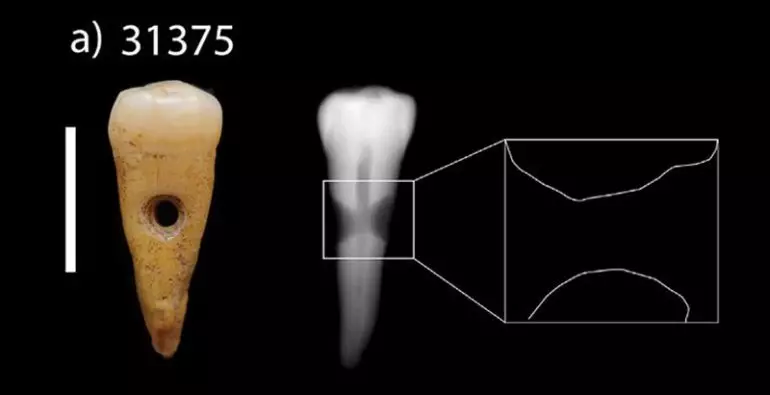 neolithic human teeth