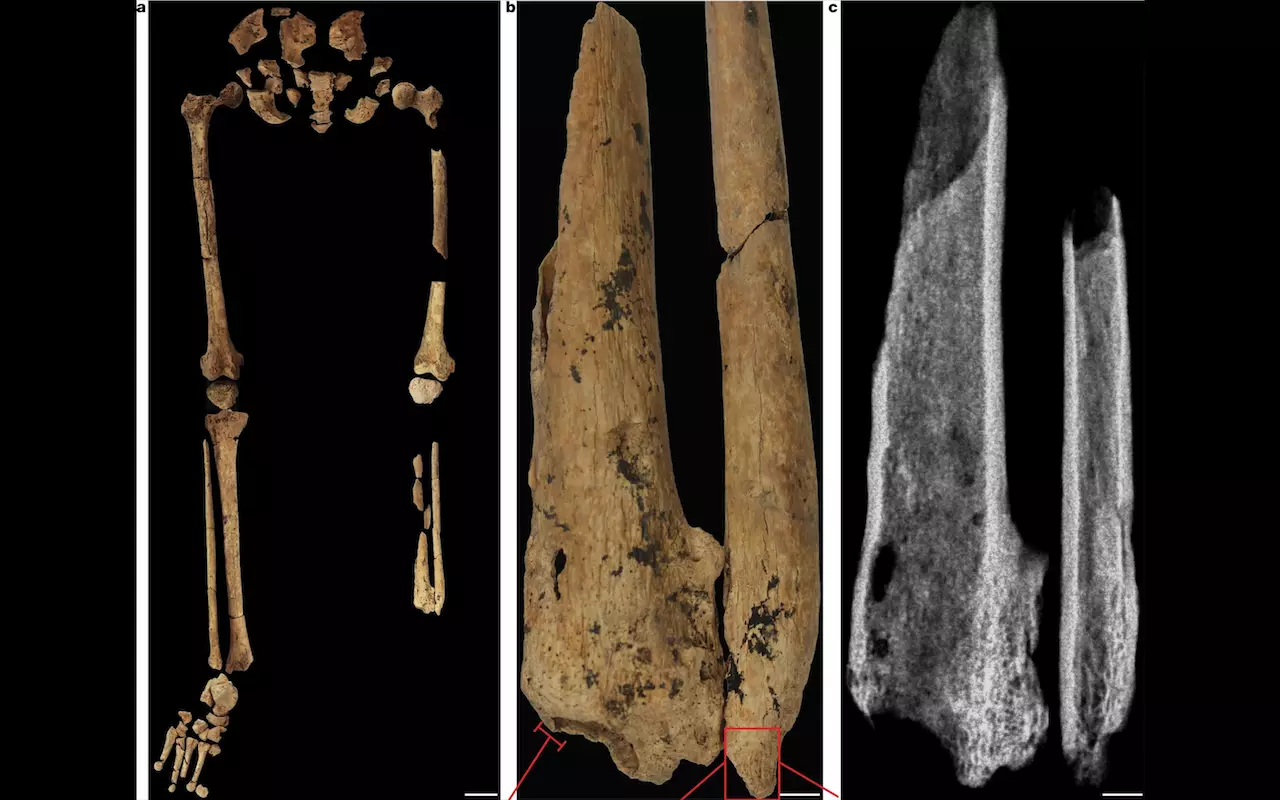 根據兒童遺骸，歷史上第一次手術發生在 31000 年前