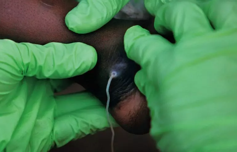 nabad gelyo guinea worm